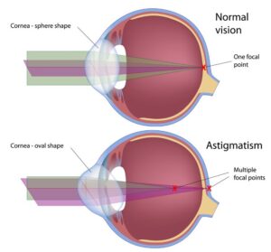 Toric Intraocular Lenses - Gary Foster MD